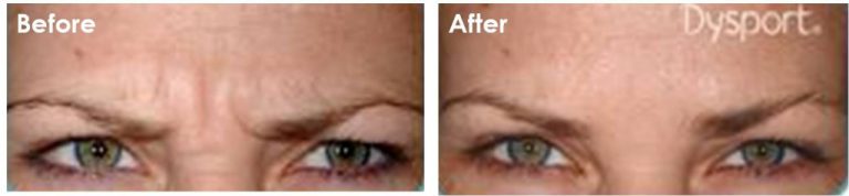Dysport® for Forehead Wrinkles | Beverly Hills | LA SkinAesthetics